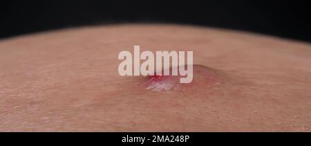 Bacterial skin infection. Big Acne Cyst Abscess or Ulcer Swollen area ...