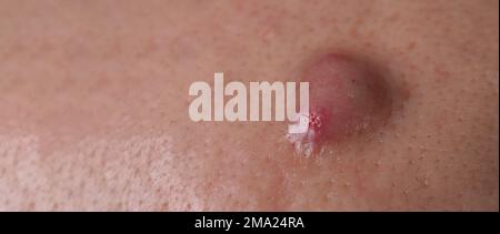 Bacterial skin infection. Big Acne Cyst Abscess or Ulcer Swollen area ...