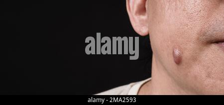 Bacterial skin infection. Big Acne Cyst Abscess or Ulcer Swollen area ...