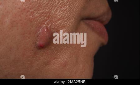 Bacterial skin infection. Big Acne Cyst Abscess or Ulcer Swollen area ...