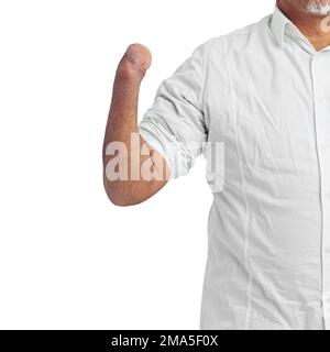 Disability, amputee and arm of a man with a disability showing forearm ...