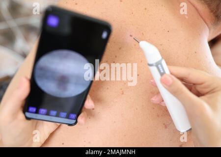 Dermatologist removes pigmentation on skin of patient close up Stock ...