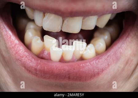 European male open mouth crooked teeth Stock Photo - Alamy