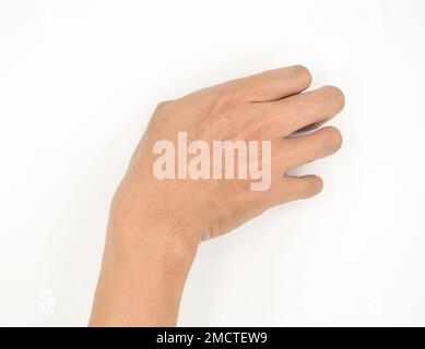 Cerebral palsy hand in Southeast Asian young male patient. Typically ...