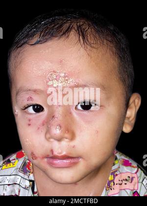 Impetigo facial sores. Bacterial skin infection and sores in a case of ...