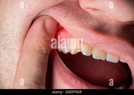 Dental abscess. Close-up of the mouth of a patient with a dental ...