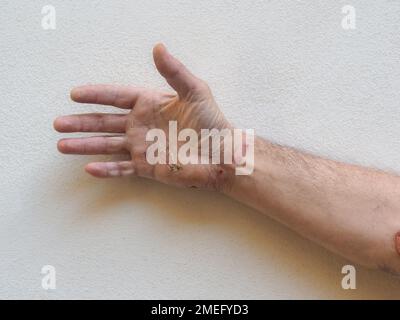 electric shock entry and exit wounds and burns in 50s adult caucasian ...