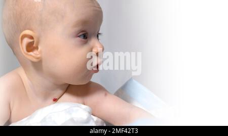 a baby with a hemangioma on his neck lies on a white background Stock ...