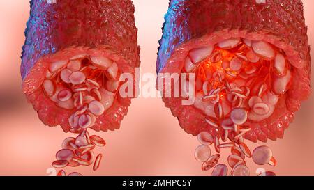 vasoconstriction and vasodilation blood pressure, dilated blood vessels ...
