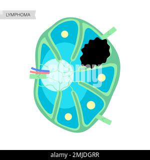 Lymphoma, conceptual illustration Stock Photo - Alamy
