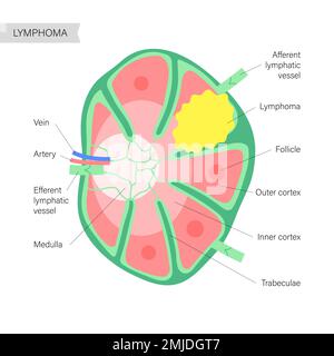 Lymphoma, conceptual illustration Stock Photo - Alamy