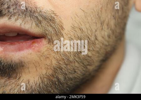 Herpes simplex infection on the lips of a senior immunocompromised male ...