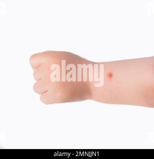Mosquito bites sore and scar on child hand, a boy scratching at lesion ...