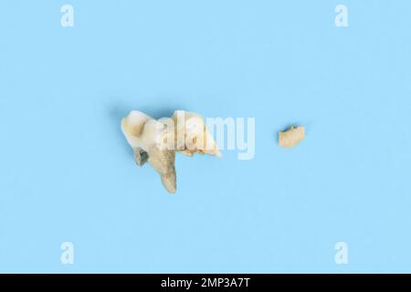 oral and dental health, tartar and black spots on the teeth Stock Photo ...