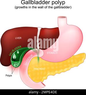Stomach polyps. Cross section of human stomach with Gastric polyps ...