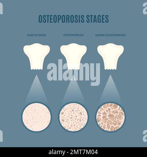 Osteoporosis bone density loss disease medical infographics Stock ...