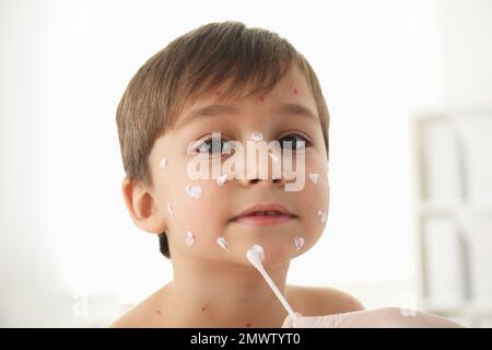 Doctor applying cream onto skin of little boy with chickenpox against ...
