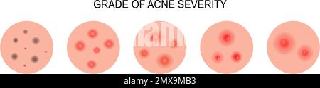 Medical diagram about Grade of acne severity Stock Vector Image & Art ...