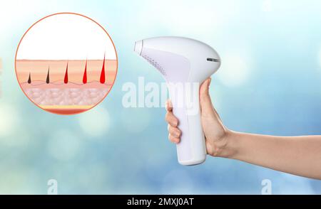 Epilation procedure. Modern appliance and illustration of hair follicle ...