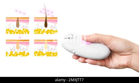 Epilation procedure. Modern appliance and illustrations of hair ...