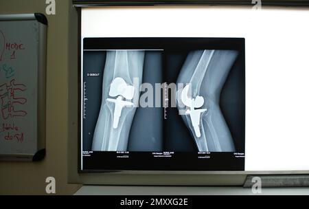 Total knee replacement x-ray - Zimmer NexGen - arthroplasty, female ...
