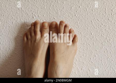Person feet with subungual hematoma, black toenails caused by trauma ...