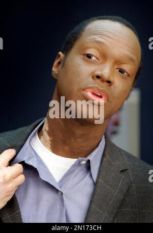 White vitiligo spot on the skin, lack of melanin Stock Photo - Alamy