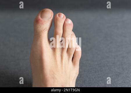 hair and wounds on male toes Stock Photo - Alamy