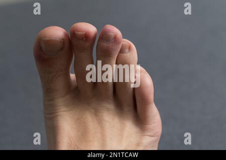 The foot, five toes, of a caucasian male with a damaged toe. Underneath ...