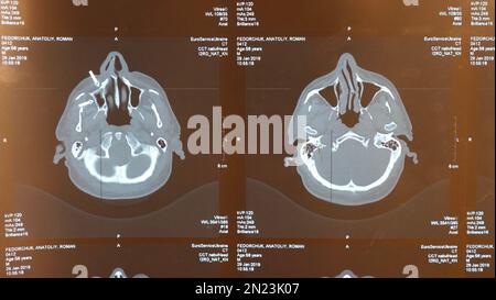Magnetic resonance imaging of an older man's brain after a traumatic ...