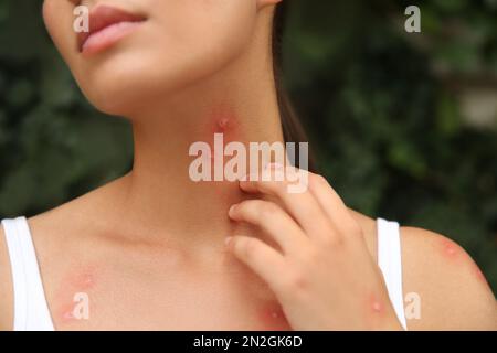Woman scratching neck with insect bites in park, closeup Stock Photo ...