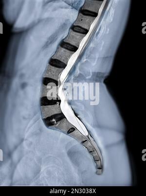 X-ray image of lumbar Spine or L-s spine lateral view for diagnosis ...