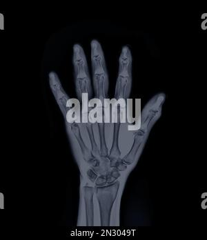 Film x-ray Left Hand AP view show human's hands isolated on black ...