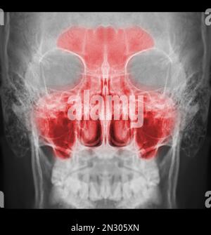 x-ray image of paranasal sinuses for diagnosis sinusitis Stock Photo ...
