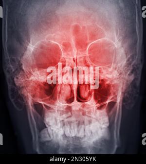 x-ray image of paranasal sinuses for diagnosis sinusitis Stock Photo ...