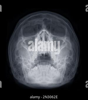 x-ray image of paranasal sinuses for diagnosis sinusitis Stock Photo ...