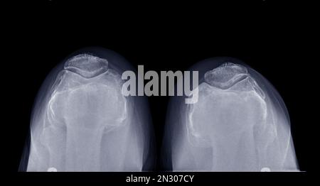 X-ray image of both patella fracture for diagnostic patella fracture or ...
