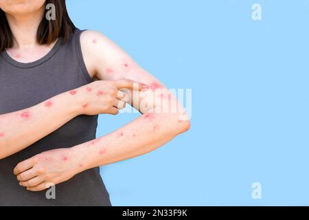 Monkeypox new disease dangerous over the world. Monkeypox virus ...