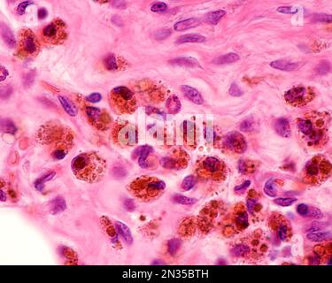 Macrophages heavily labelled with colloidal iron. Colloidal iron can be ...