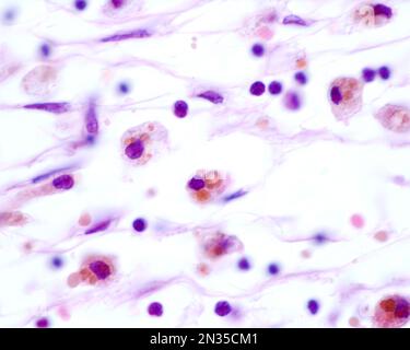Macrophages showing large brown inclusions originated by phagocytosis ...