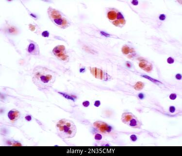 Macrophages showing large brown inclusions originated by phagocytosis ...