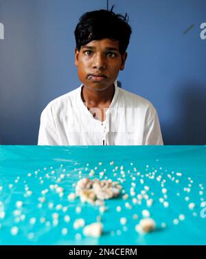 Ashik Gavai, 17, sits near 232 teeth removed from his jaw after ...