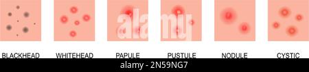 Stages of skin acne anatomy illustration Stock Vector Image & Art - Alamy