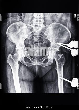 x-ray with external fixation device fixed in bones Stock Photo - Alamy