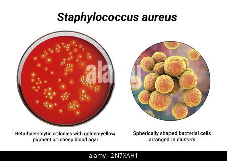 Colonies of Staphylococcus aureus bacteria, illustration Stock Photo ...