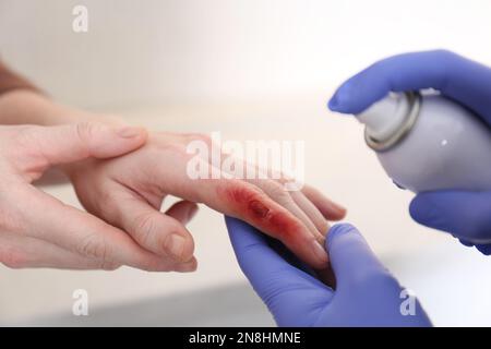 Applying burn spray onto injured skin, closeup Stock Photo - Alamy