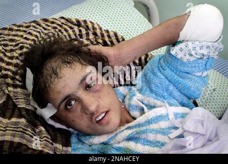 Fifteen year-old Sahar Gul, shows her hand displaying a finger where he ...