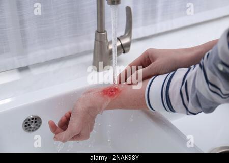 Woman holding forearm with burn under flowing water indoors, closeup ...