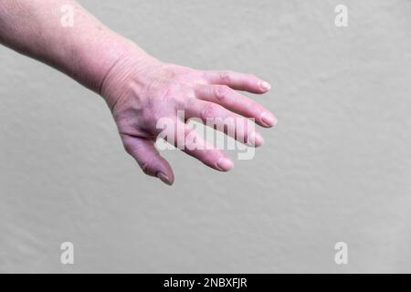 Hand Of Woman Deformed From Rheumatoid Arthritis Stock Photo - Alamy