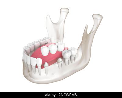 3d render of mandible with dental bridge over molar and premolar teeth ...